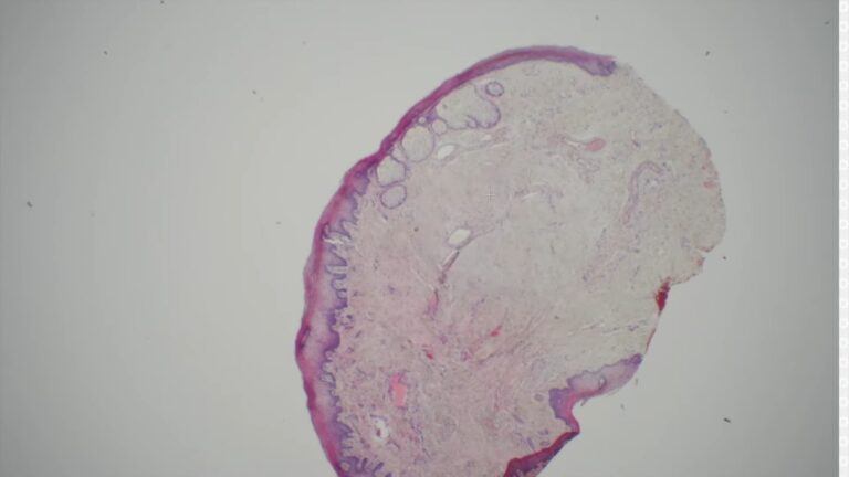 How to Deal with Fordyce Spots on the Vulva - Say Goodbye to Worries