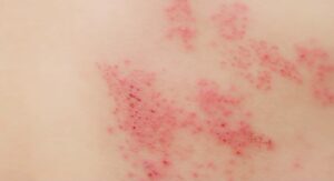The Different Stages of Syphilis Infection and the Symptoms