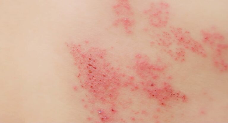 The Different Stages of Syphilis Infection and the Symptoms