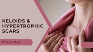 Keloids & Hypertrophic Scars - Common Lumps & Bumps